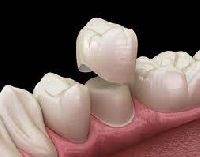 Porcelain Crown at Best Price from Manufacturers, Suppliers & Traders